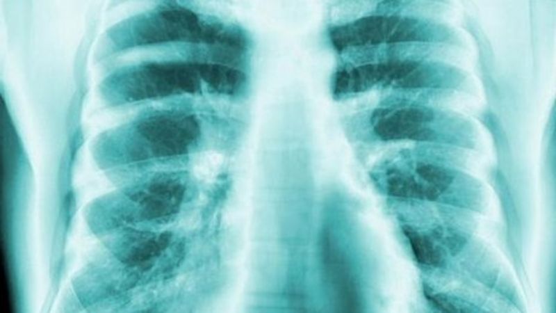 'I have tuberculosis in my brain' - BBC News