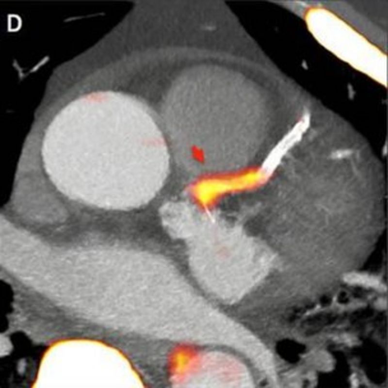 Heart attack risk identified by new scan - BBC News