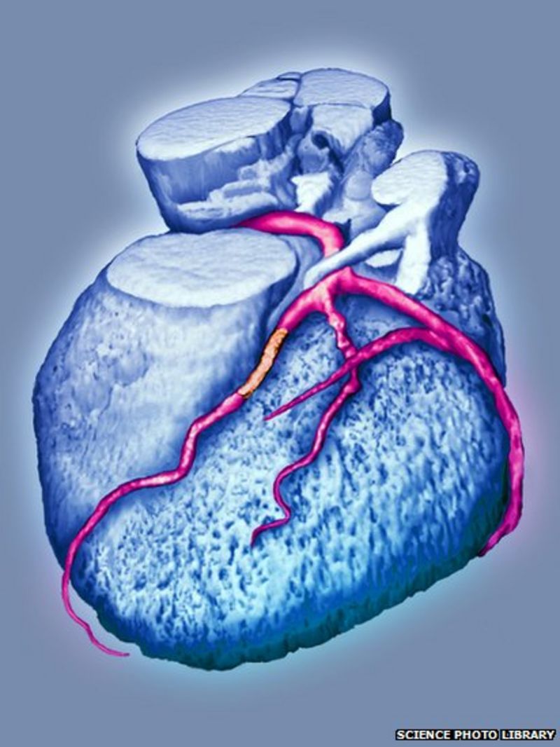 Angioplasty and its revolutionary impact over 50 years - BBC News