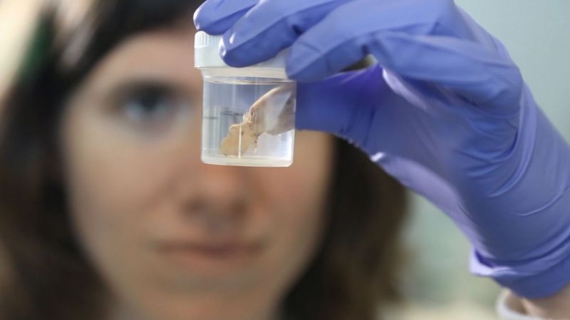 Man died with 'tapeworm tumours' - BBC News