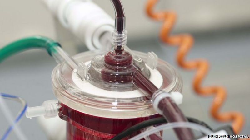 Glenfield's 'experimental' ECMO unit celebrates 25 years - BBC News