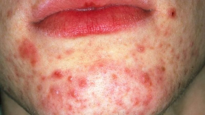 'I woke up one day with severe acne' - BBC News