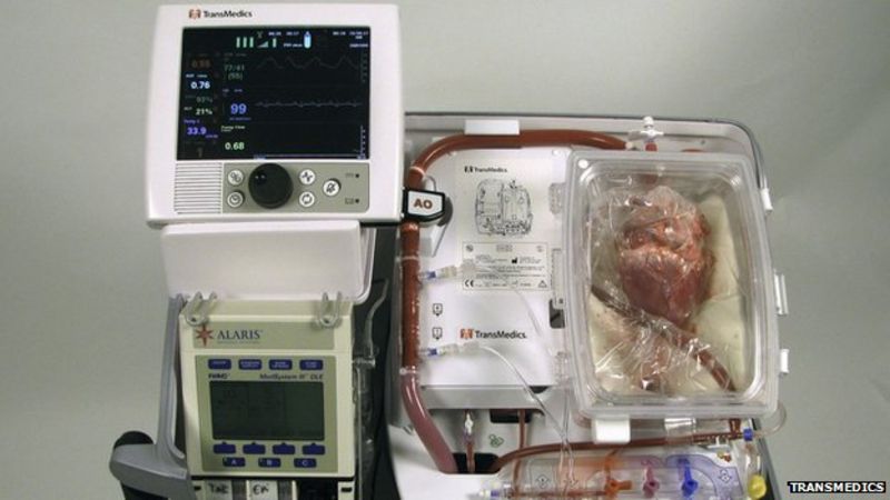 Europe's first non-beating heart transplant - BBC News