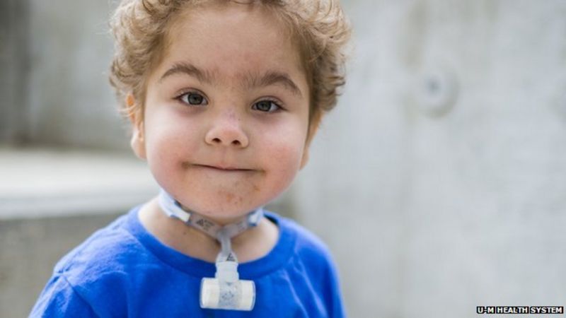 3D windpipe 'saves children's lives' - BBC News