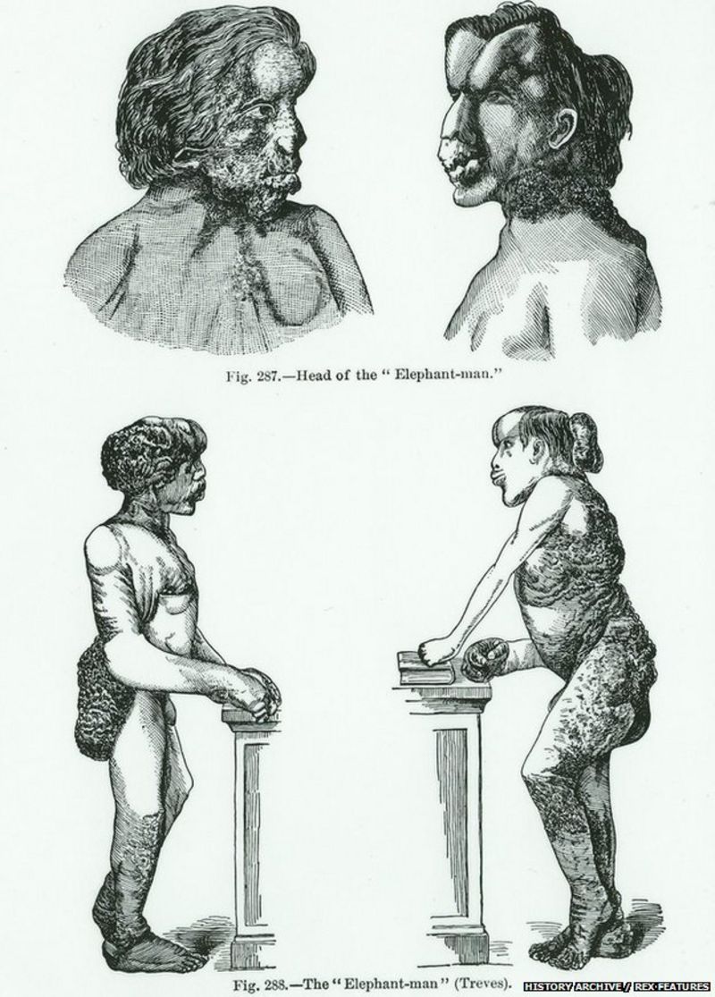 How the story of The Elephant Man was almost forgotten - BBC News