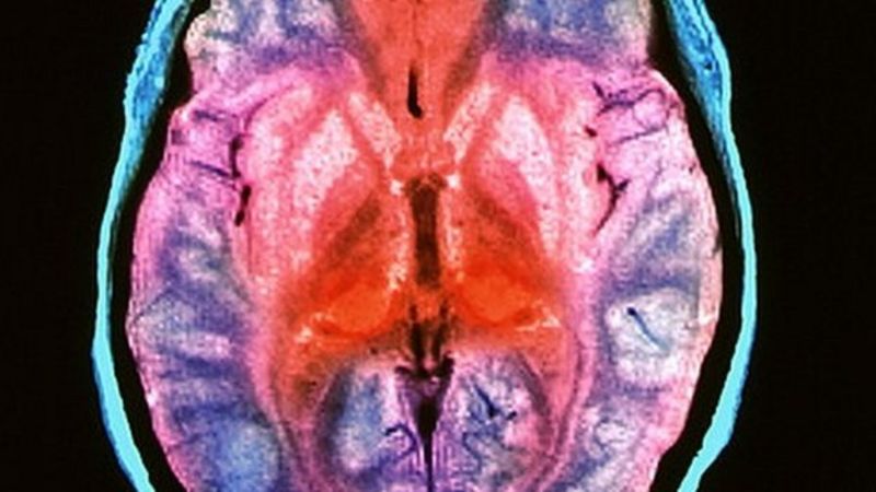 Pioneering CJD treatment to be used on British patient - BBC News