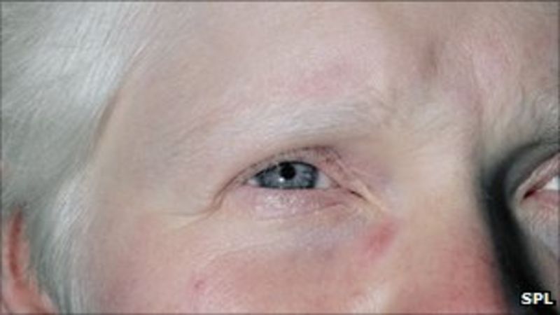 Drug 'aids albino people's sight' - BBC News