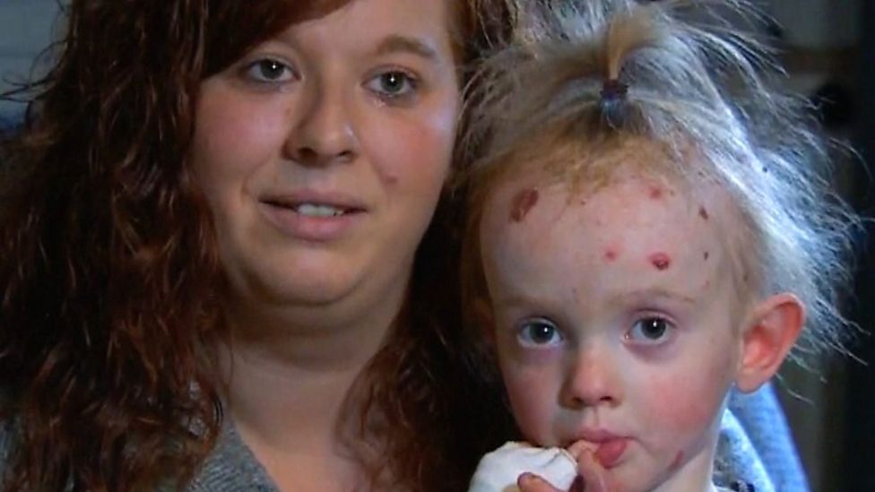 My 'butterfly skin' could kill me but I want to raise awareness for ...