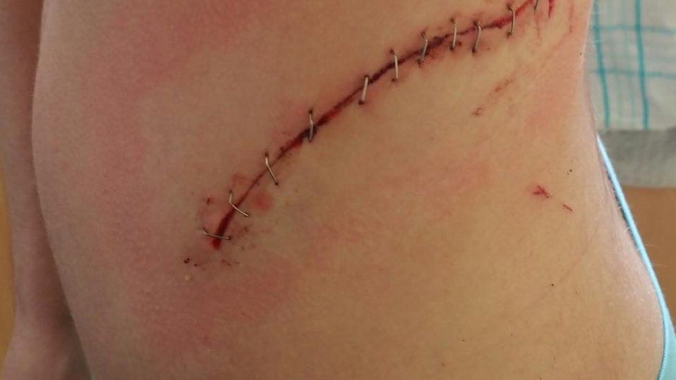 Newtownards bonfire: Man suffers 'horrific injuries' during assault ...