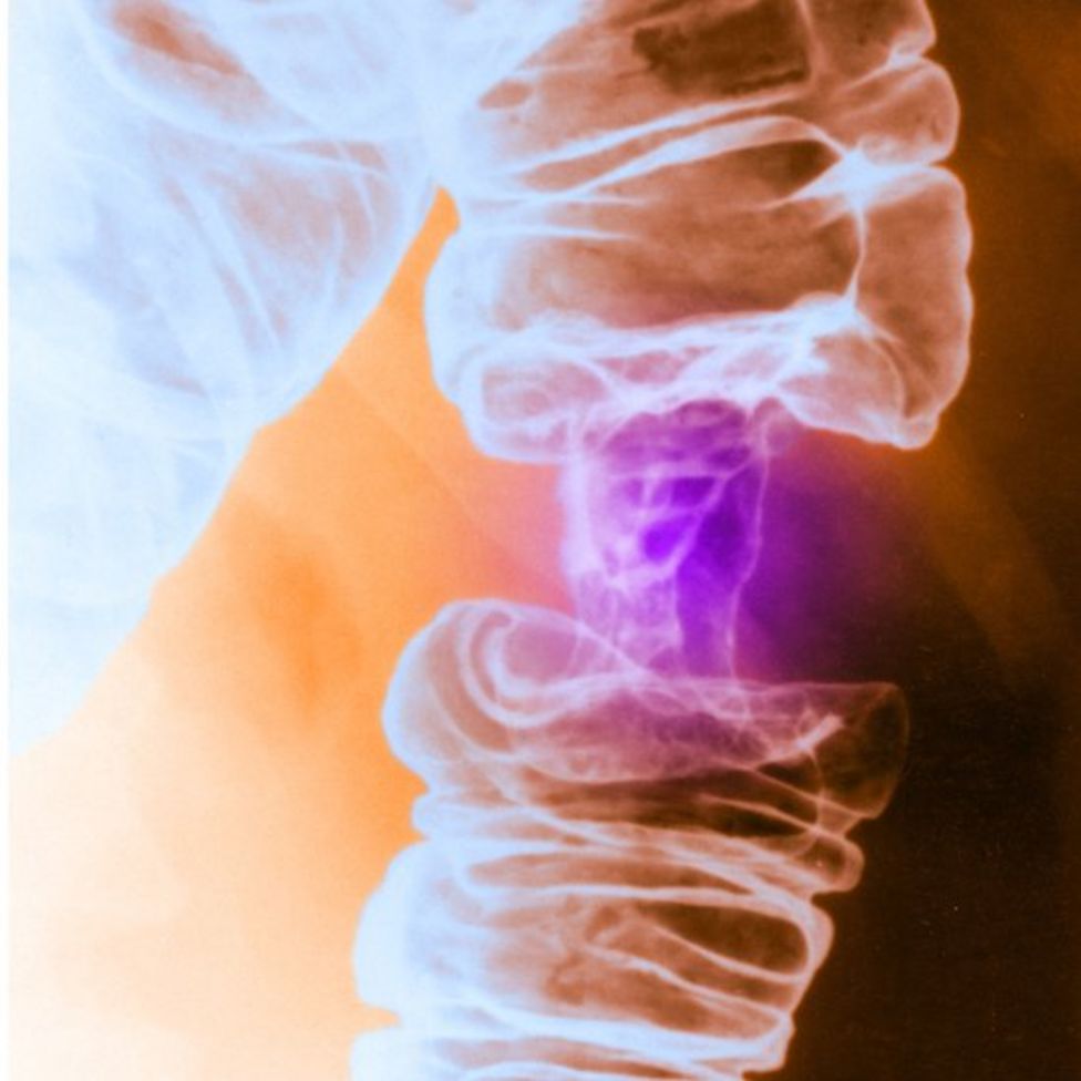 Bowel cancer: Stents 'may prevent need for colostomy bags' - BBC News