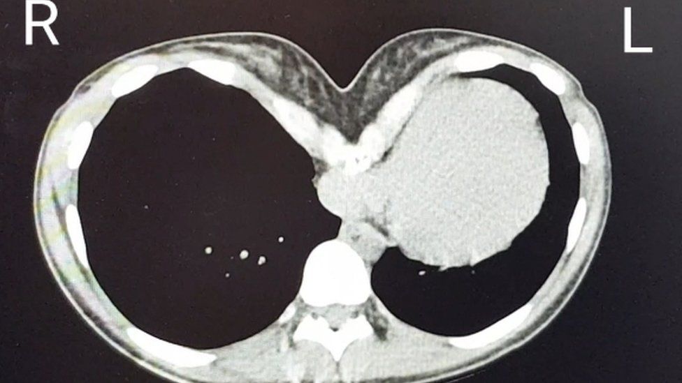 Sunken chest syndrome: 'I'm being strangled inside' - BBC News