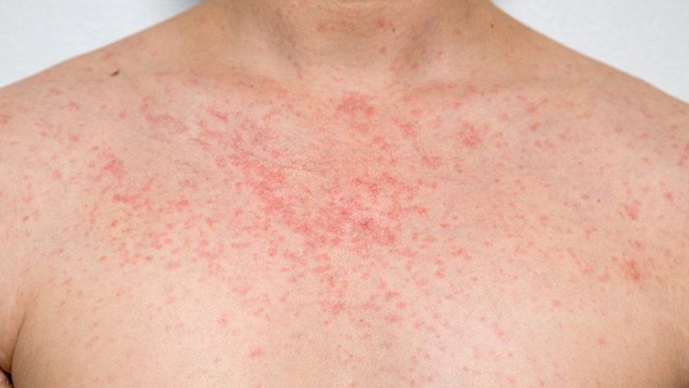 Measles: Third case in Irish Republic after Abu Dhabi to Dublin flight ...