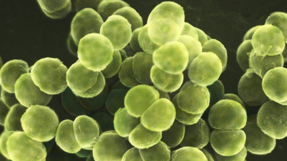 Antibiotic-coated tubes 'could cut child infection rates' - BBC News