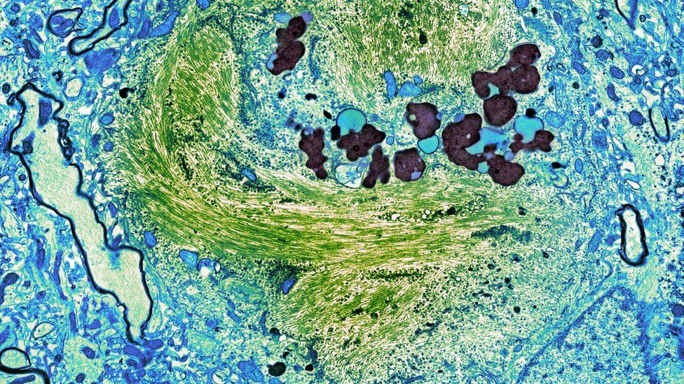 Drug 'may slow' Alzheimer's brain death - BBC News