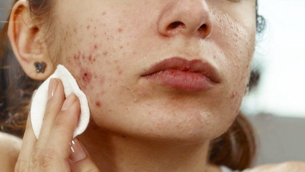 'Effaith acne ar iechyd meddwl ddim yn cael ei gymryd o ddifrif' - BBC ...