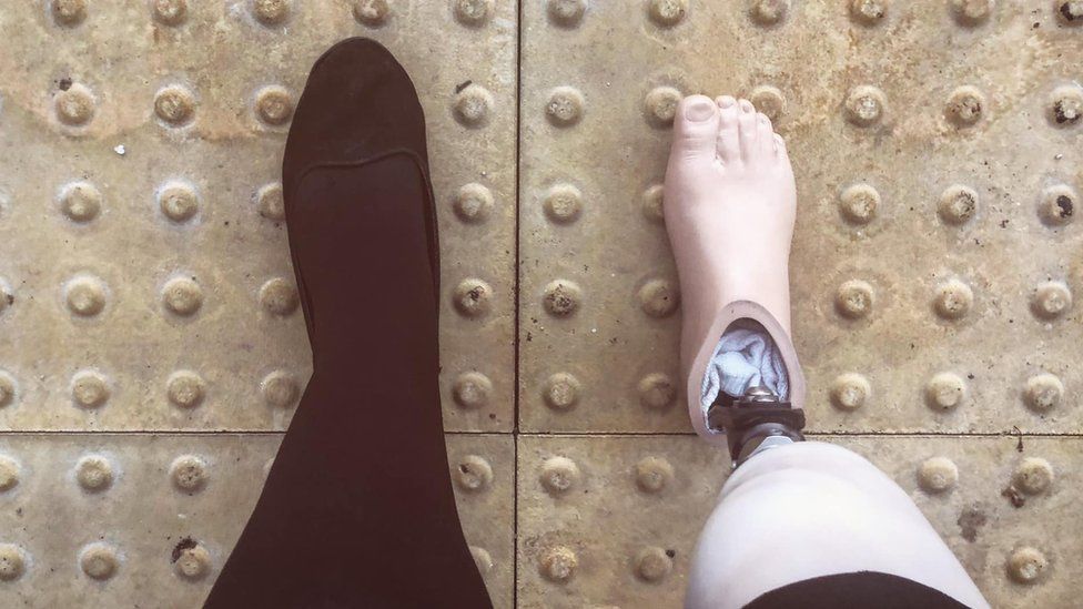 'Why I chose to have my leg amputated' - BBC News