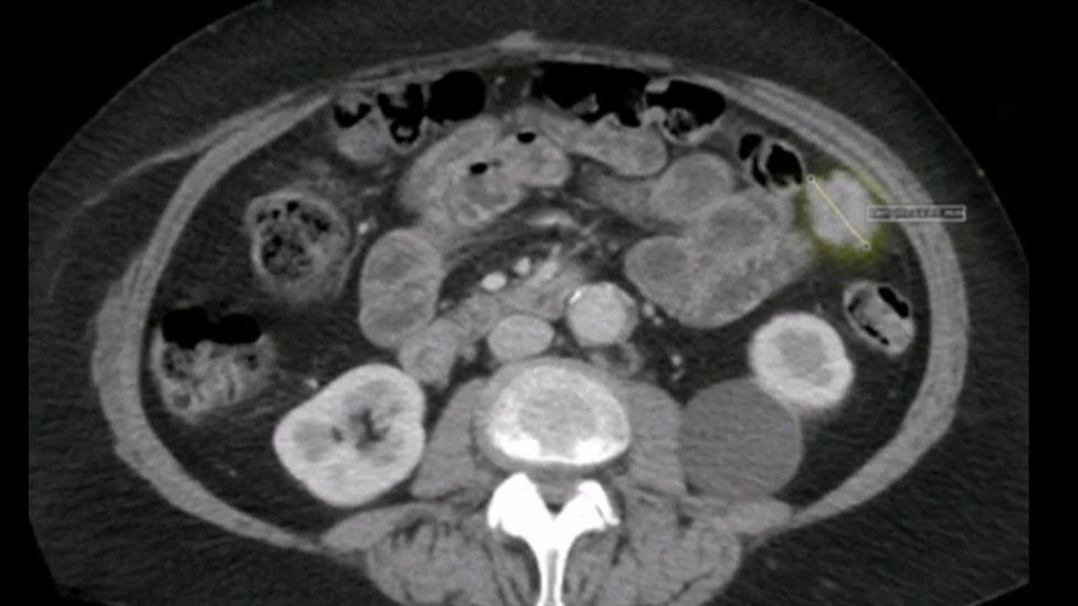 Leeds woman given terminal diagnosis after doctors missed tumour on ...