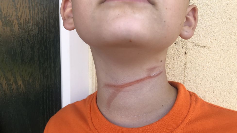 March mother's warning after son injured by dog lead - BBC News