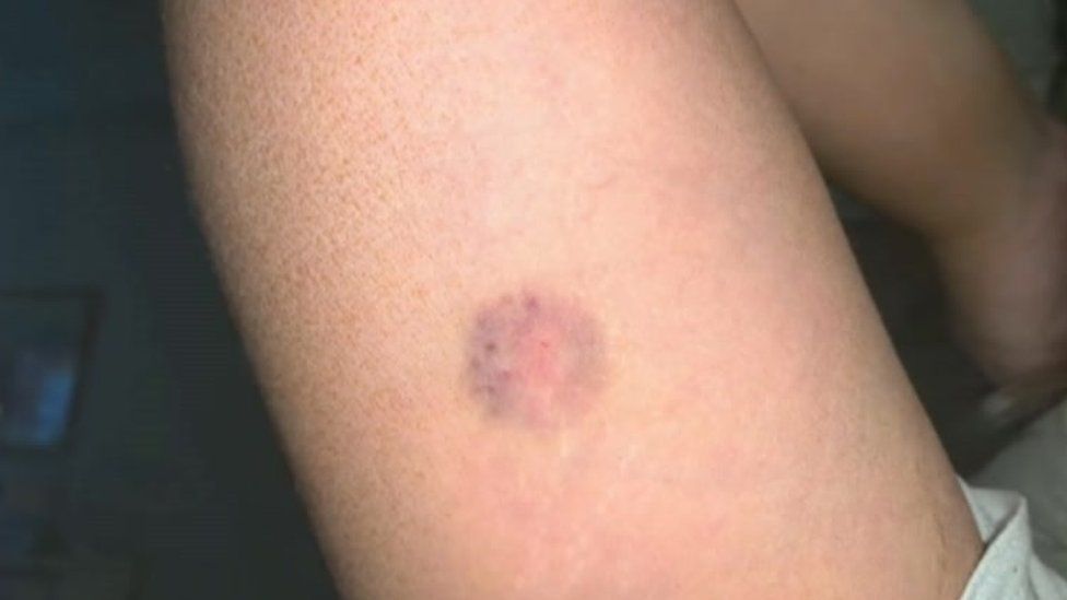 Spiked Gloucester student backs MP to make act a crime - BBC News