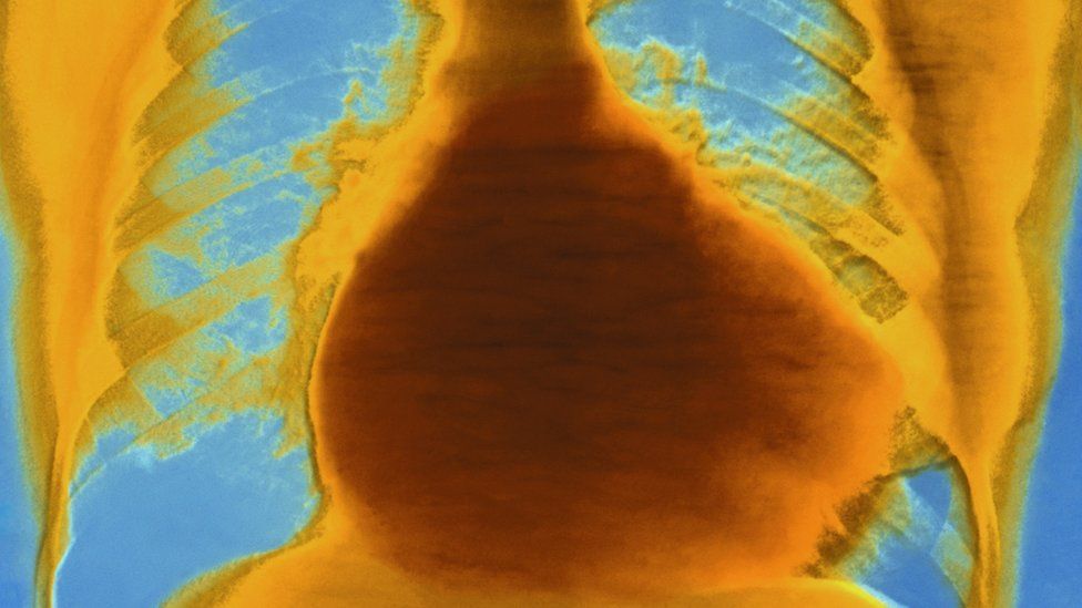 Cardiac 'bruising' may predict worse heart attack - BBC News