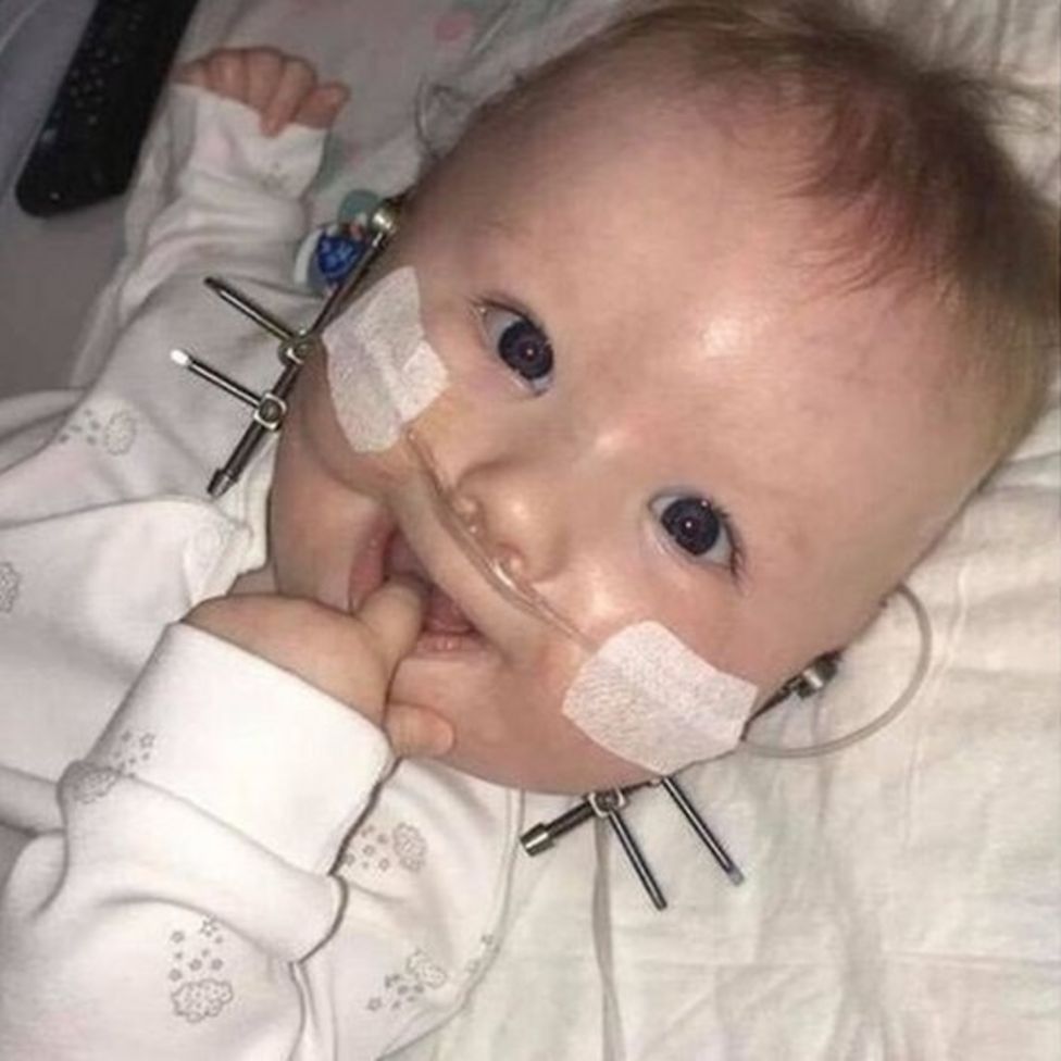 Jaw 'scaffolding' operation helps our baby breathe - BBC News