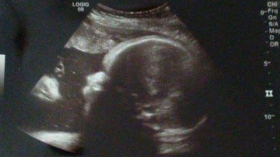 Pennsylvania couple sees 'Jesus' in ultrasound of baby - BBC News