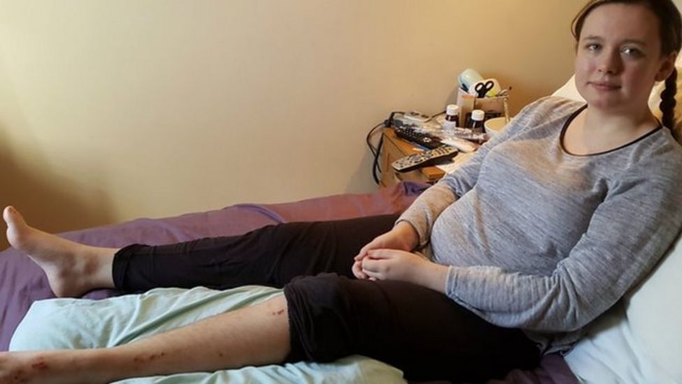 Woman who wanted an amputation says other leg now paralysed - BBC News
