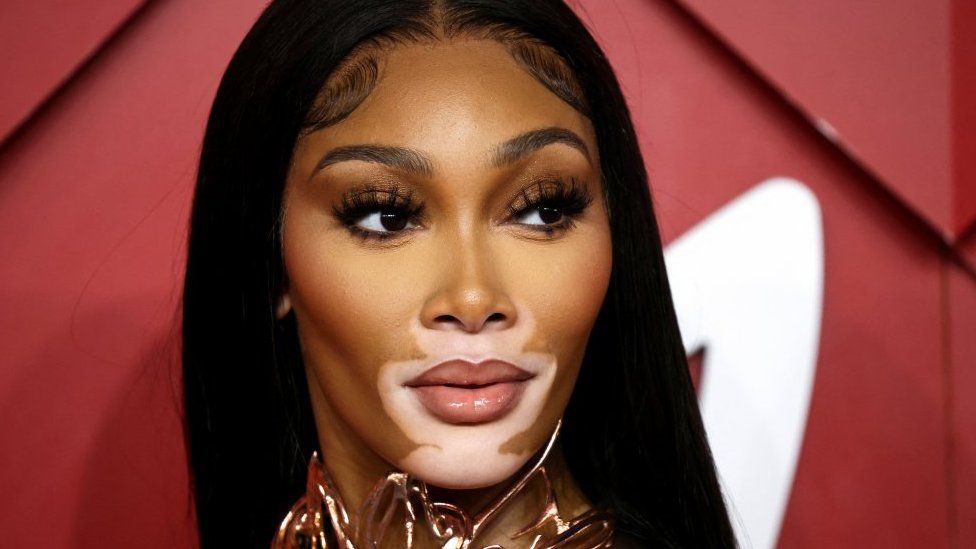 Vitiligo: Why I won't be using controversial treatment - BBC News