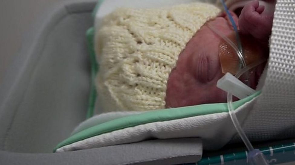 Outlook for extremely premature babies 'improving' - BBC News