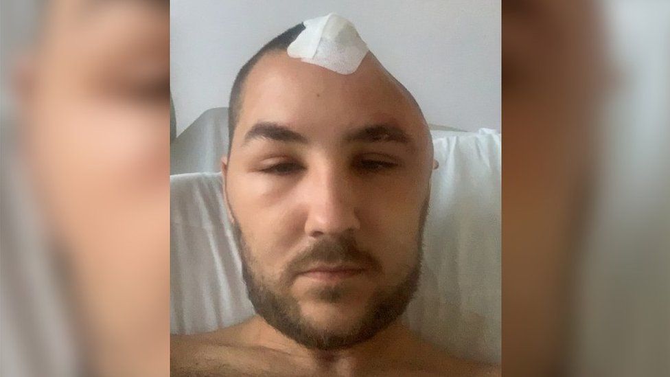 Man has part of skull removed after Mansfield attack - BBC News