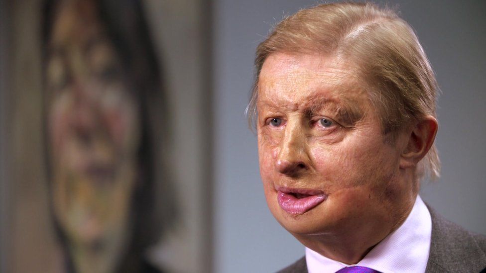 The children living with facial disfigurements - BBC News