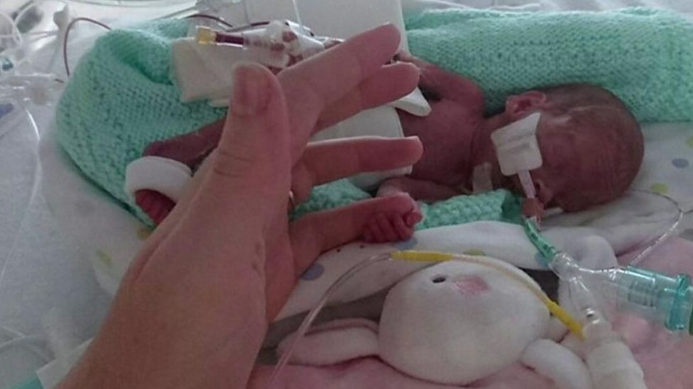 Baby born four months early survives surgery at Tooting hospital - BBC News