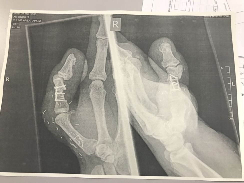 Sutton-in-Ashfield man's severed thumb replaced with big toe - BBC News