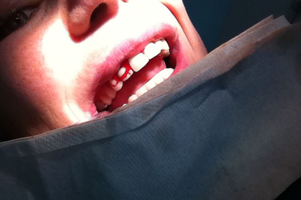 'The screeching drill, the burnt flesh - my dental nightmare' - BBC News