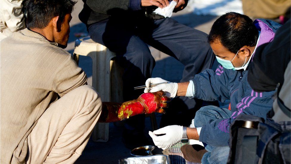 Swansea team gets £2m to help tackle global burns problem - BBC News