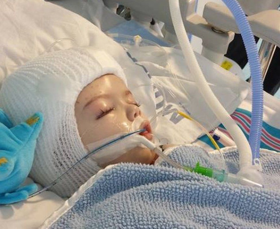 Surgeons in New York separate twins conjoined at the head - BBC News