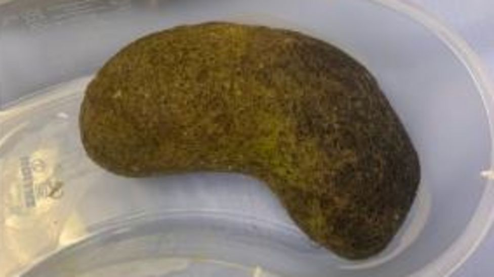 'Horrific' hairball removed from Teesside girl's stomach - BBC News