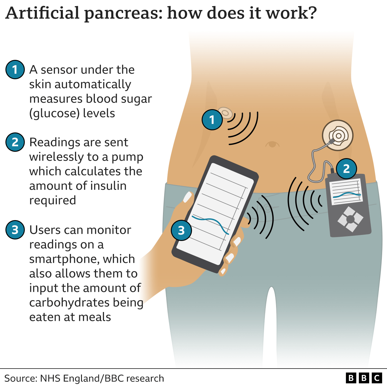 Artificial pancreas to revolutionise diabetes care in England - BBC News