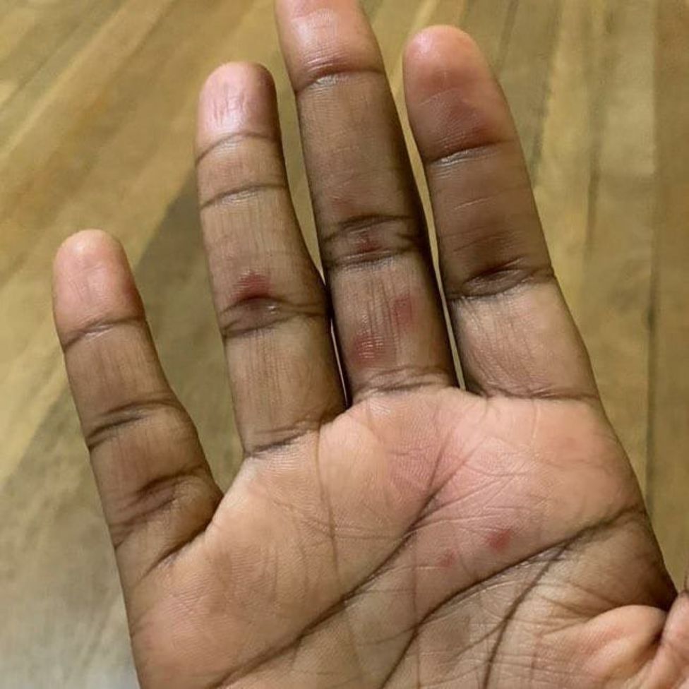 What do medical conditions look like on darker skin? - BBC Newsround