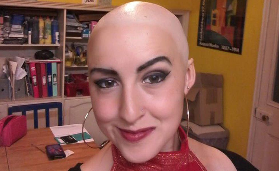 Alopecia: Brecon dancer, 25, tackles hair loss head on - BBC News