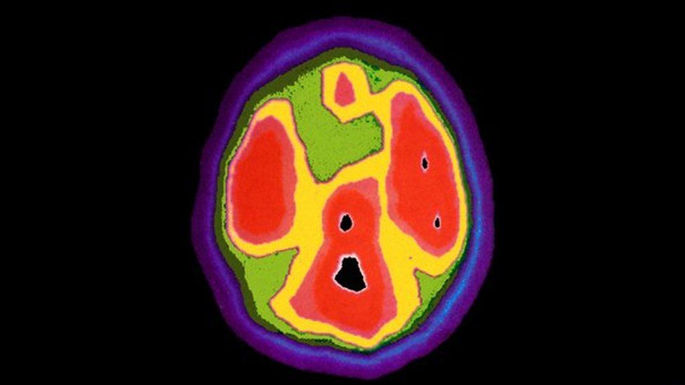 Yorkshire children face six-month autism test wait - BBC News