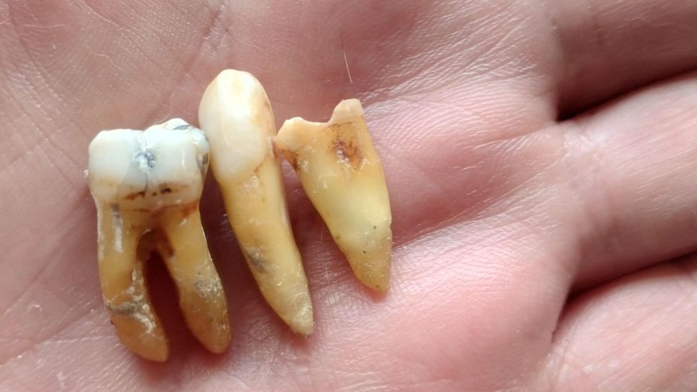 Devon woman extracts her own teeth due to lack of dentist - BBC News