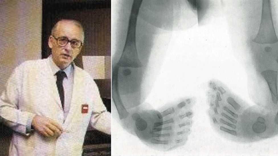 Spain's forgotten Thalidomide victims see glimmer of hope - BBC News