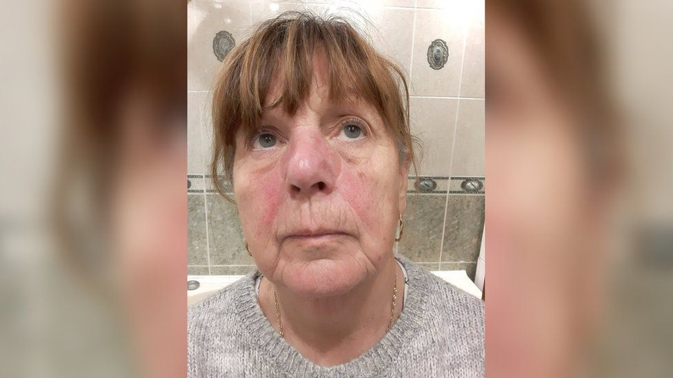 Rosacea: 'Your skin doesn't define you' - BBC News