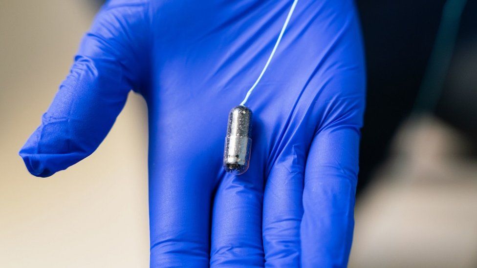 Scotland first to use 'sponge on a string' pill as cancer test - BBC News