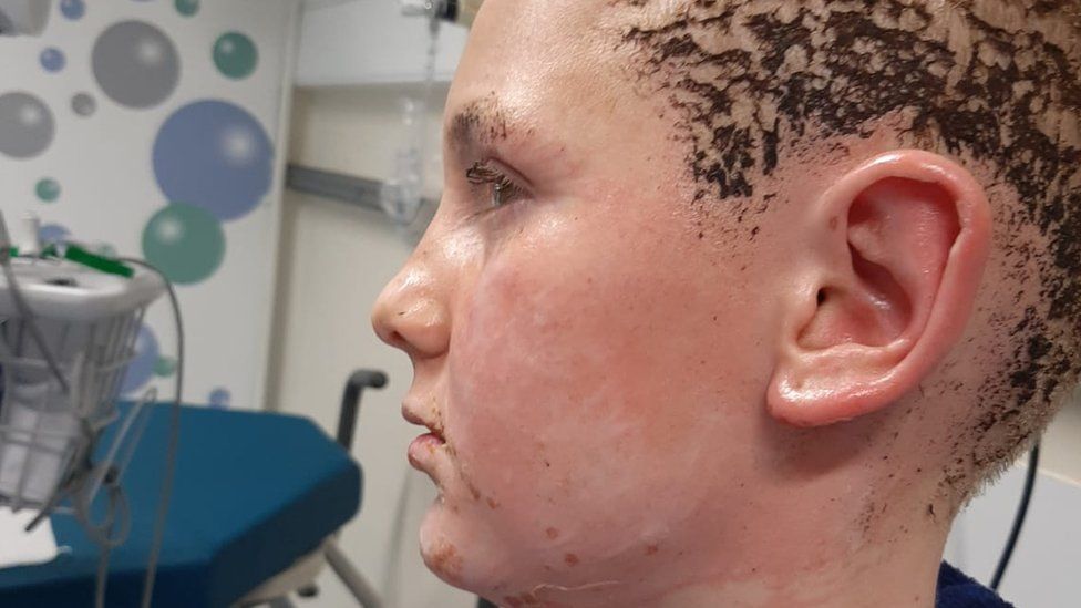 Belfast: Boy burned in online copycat stunt - BBC News