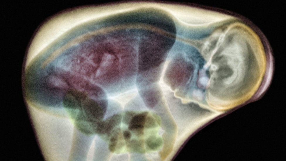 Extra baby scan 'spots brain problems' - BBC News