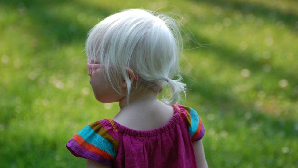 How Frozen's Elsa helped a little girl with albinism - BBC News