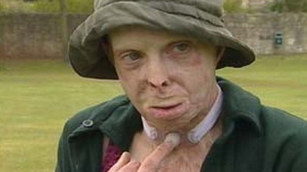 Jacqueline Kirk who was set alight by ex 'got on with life' - BBC News