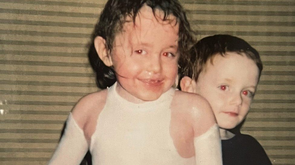 Rare skin condition leads to stares and comments from strangers - BBC News